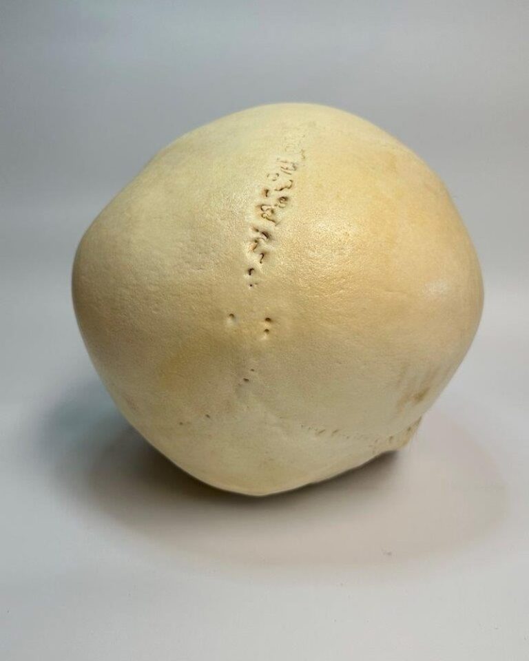 Male Skull with Severe Underbite - Osta International